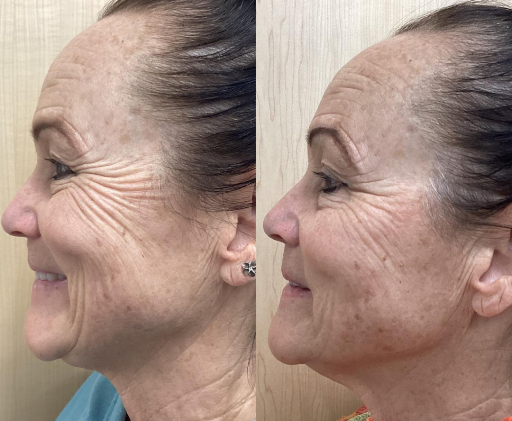 Skin Laxity - Elite Medi Spa